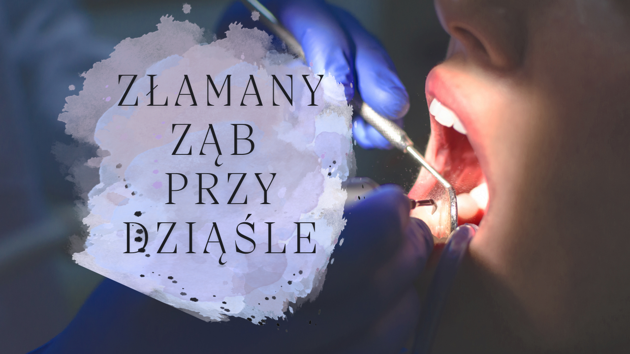 Złamany ząb przy dziąśle - co robić i jak wygląda leczenie? - Denteamed ...